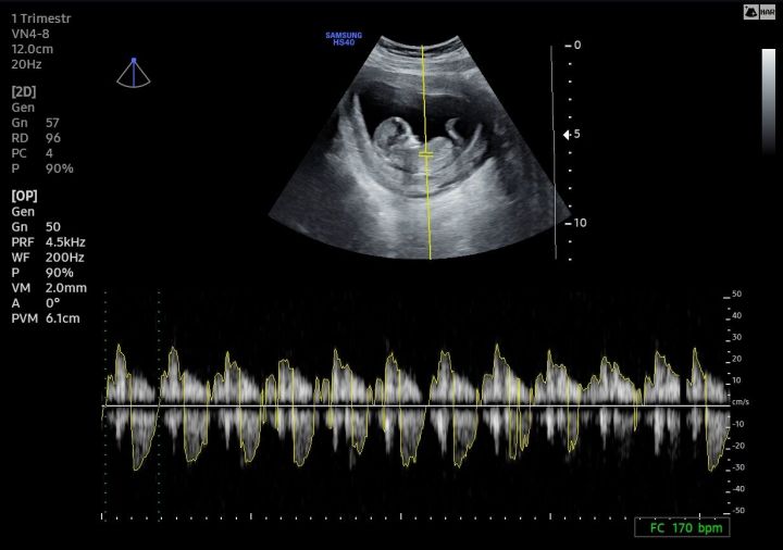 Ecografía 5D a las 12 Semanas: Imágenes Claras y Detalladas