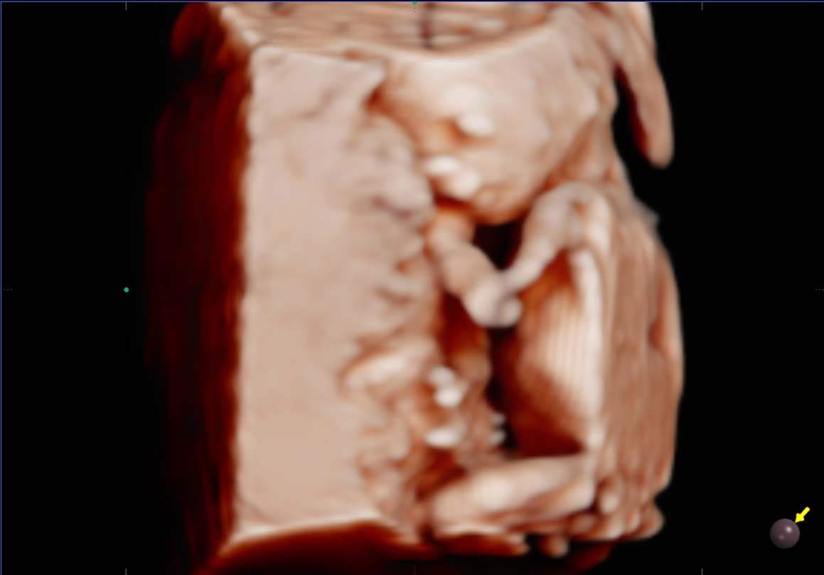 Ecografia Anatomia Bebe